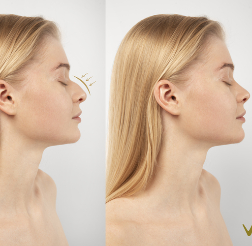 Injection Nez Acide hyaluronique: Rhinoplastie médicale